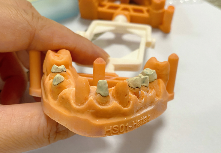 What is Dental Lab Post and Core? - orangedentalstudio