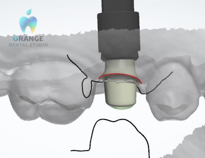 Cement-Retained vs. Screw-Retained Implant Crowns - orangedentalstudio