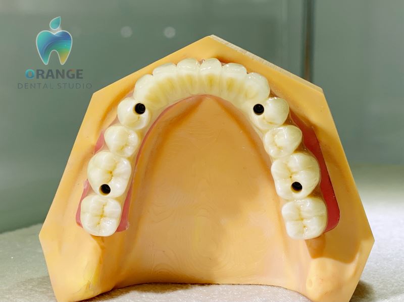 Cement-Retained vs. Screw-Retained Implant Crowns - orangedentalstudio